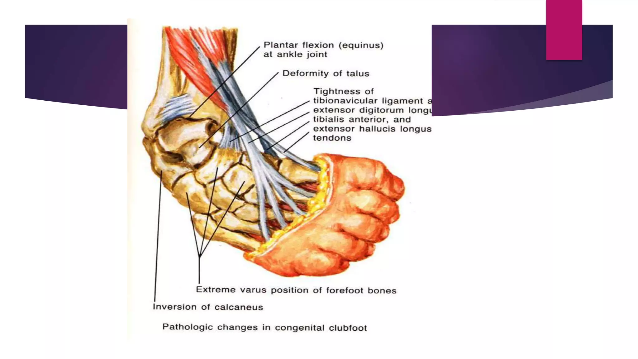 Congenital talipes equinus varus | PPTX