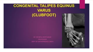 Congenital talipes equinus varus | PPTX