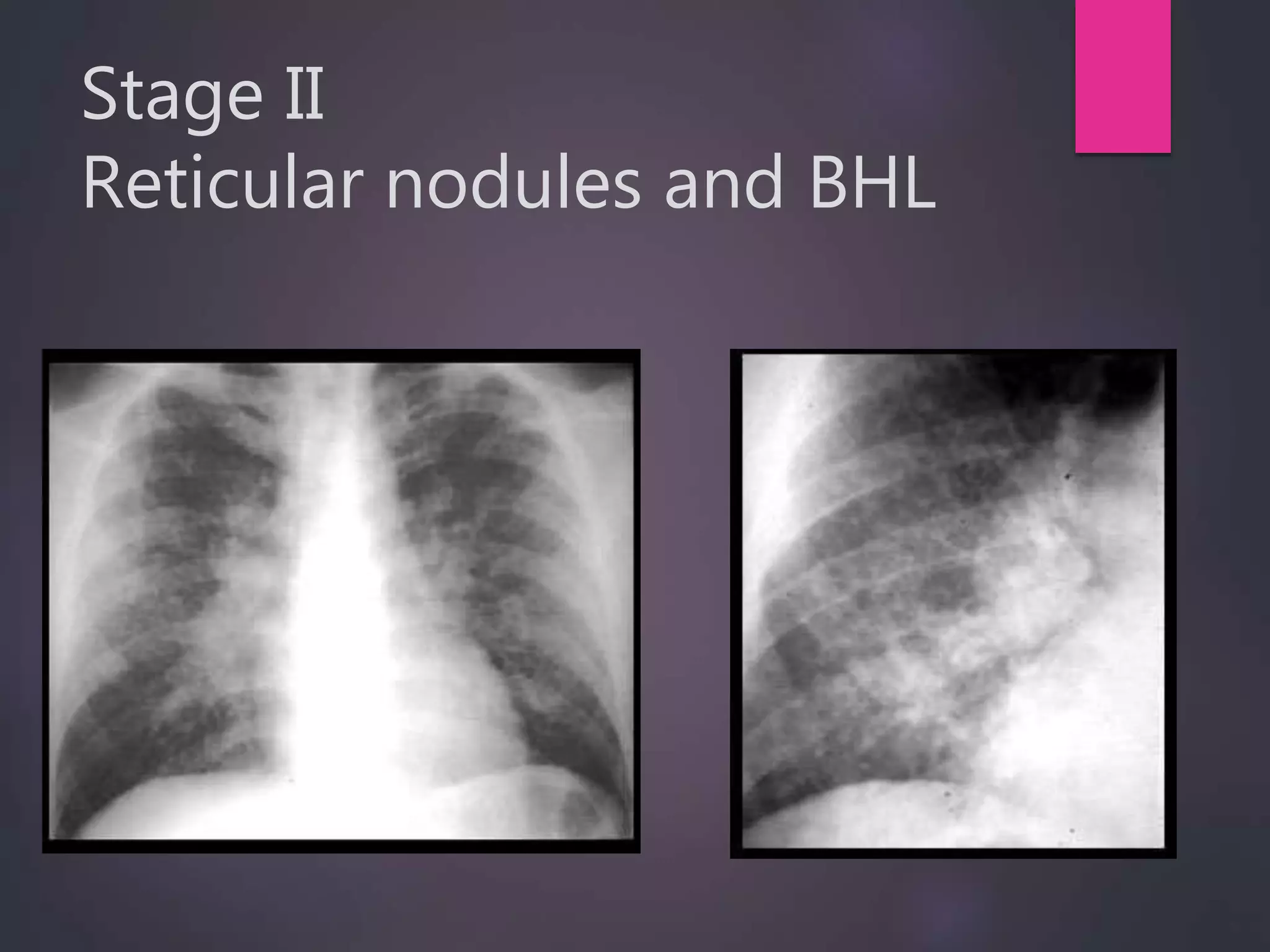 interstitial lung disease (ilD) | PPT