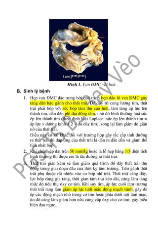 HẸP VAN ĐỘNG MẠCH CHỦ | PDF
