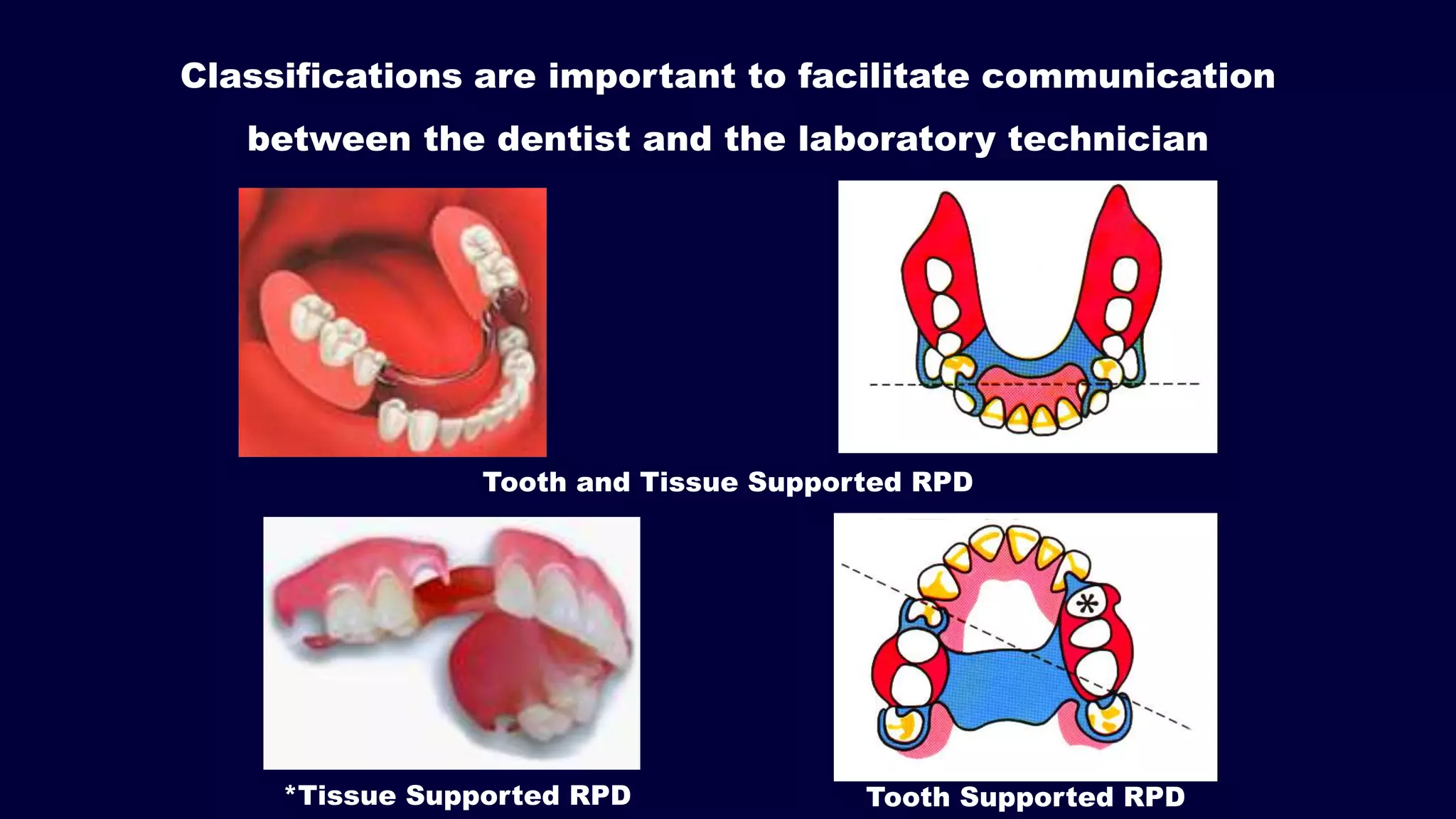 1. Introduction and forces acting on Removable Partial Denture (RPD). | PPT