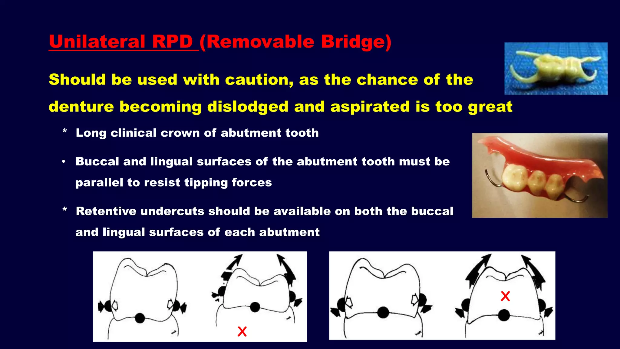 1. Introduction and forces acting on Removable Partial Denture (RPD). | PPT