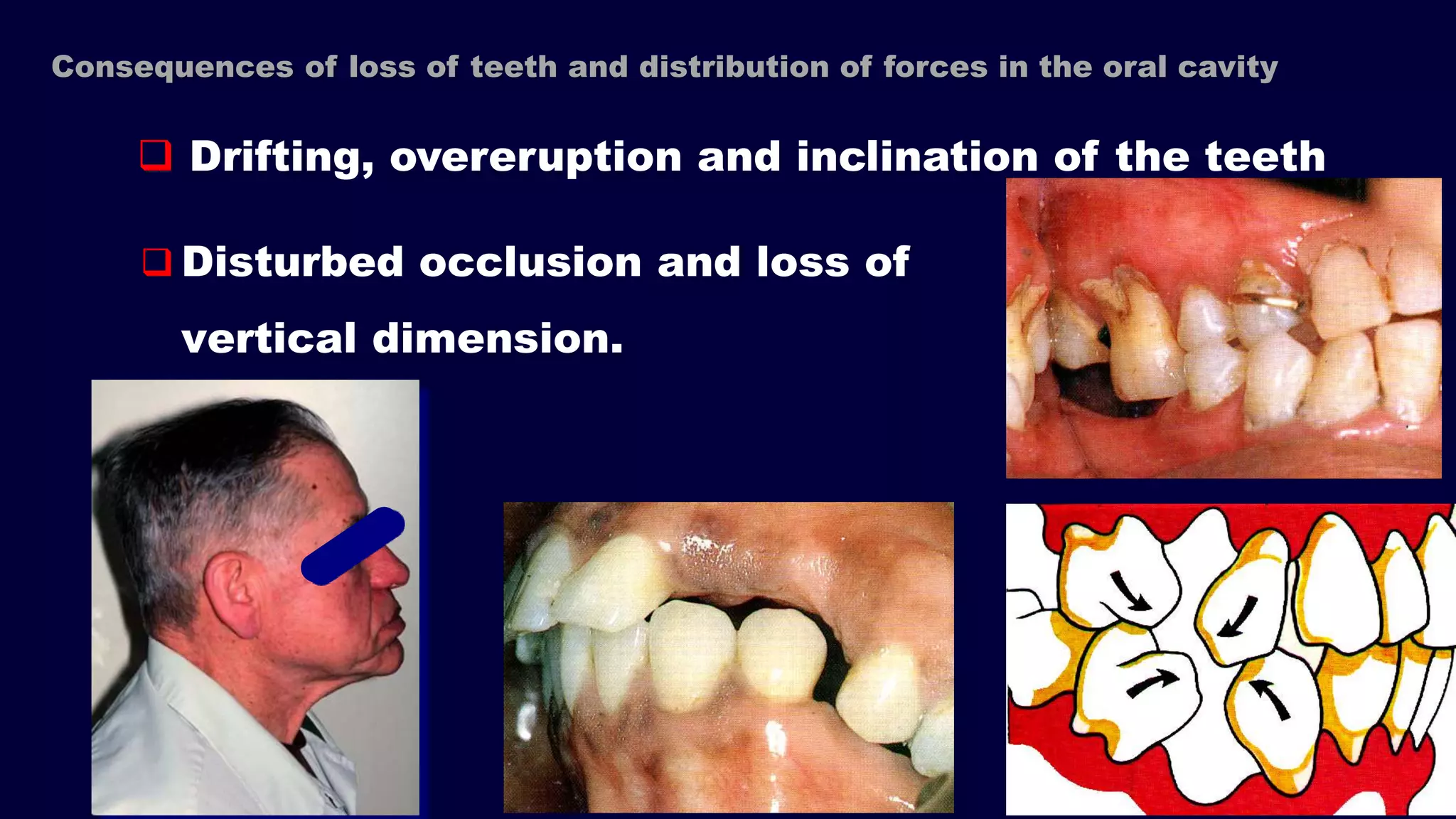 1. Introduction and forces acting on Removable Partial Denture (RPD). | PPT