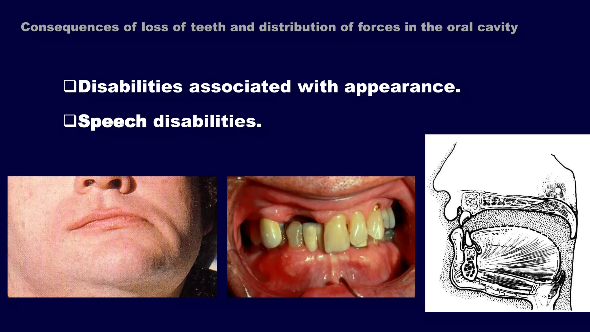 1. Introduction and forces acting on Removable Partial Denture (RPD). | PPT