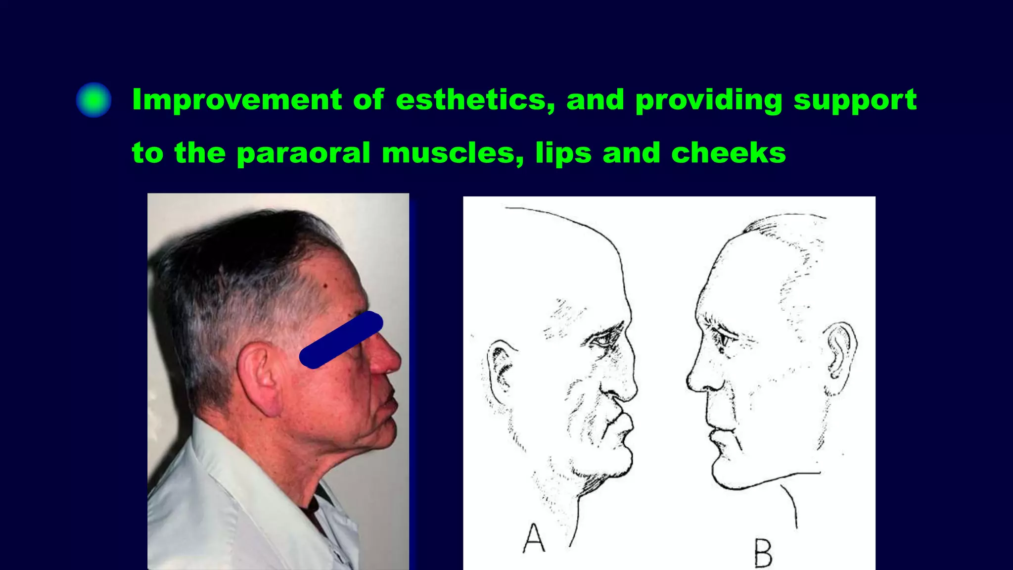 1. Introduction and forces acting on Removable Partial Denture (RPD). | PPT