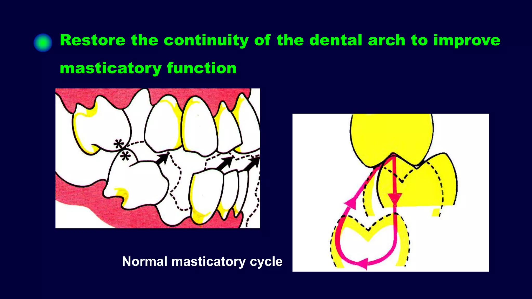 1. Introduction and forces acting on Removable Partial Denture (RPD). | PPT
