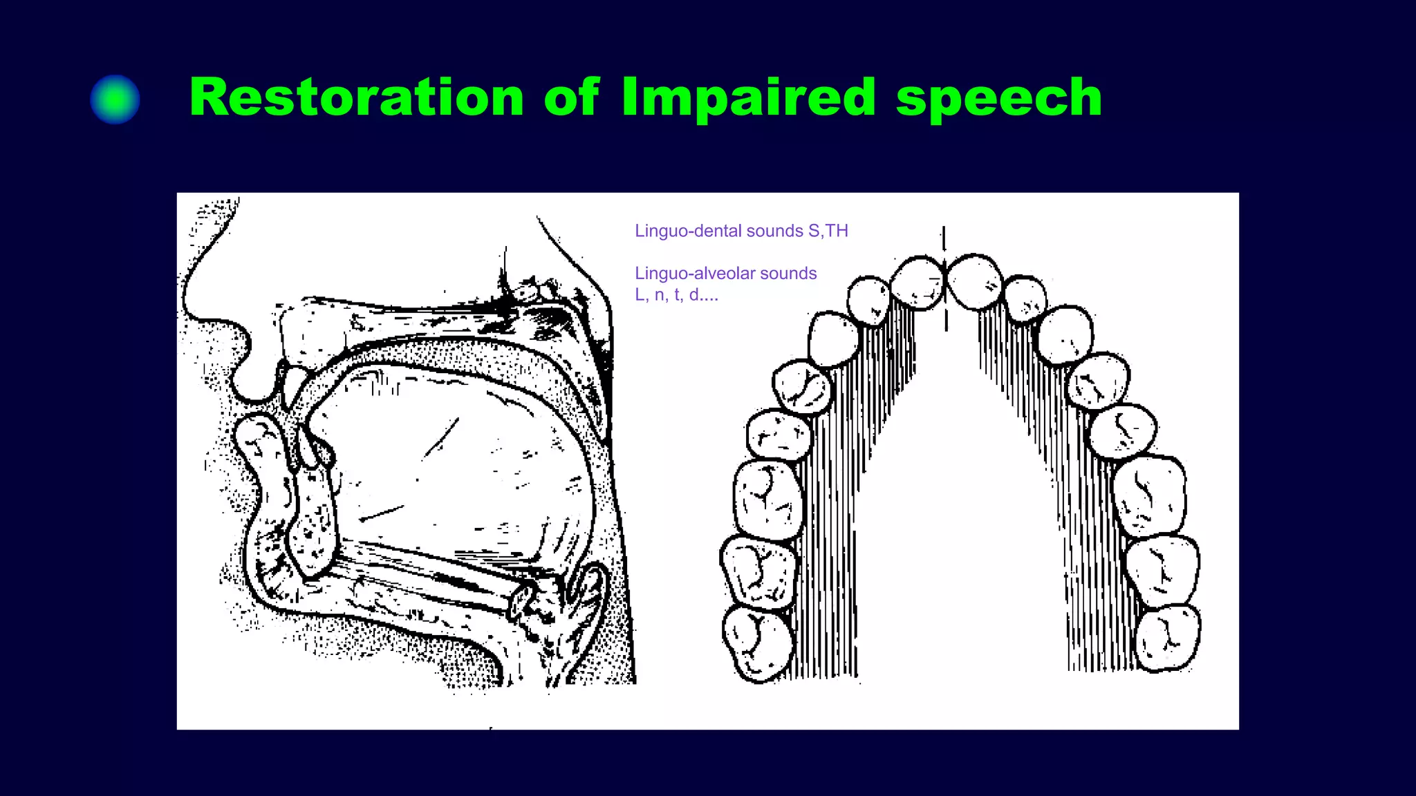 1. Introduction and forces acting on Removable Partial Denture (RPD). | PPT