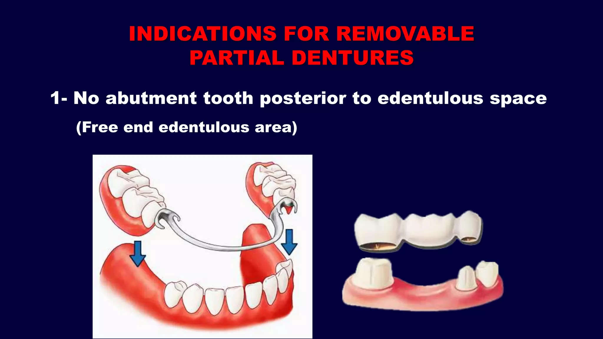 1. Introduction and forces acting on Removable Partial Denture (RPD). | PPT