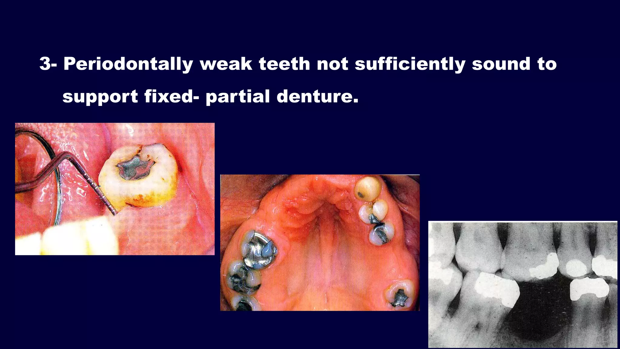 1. Introduction and forces acting on Removable Partial Denture (RPD). | PPT