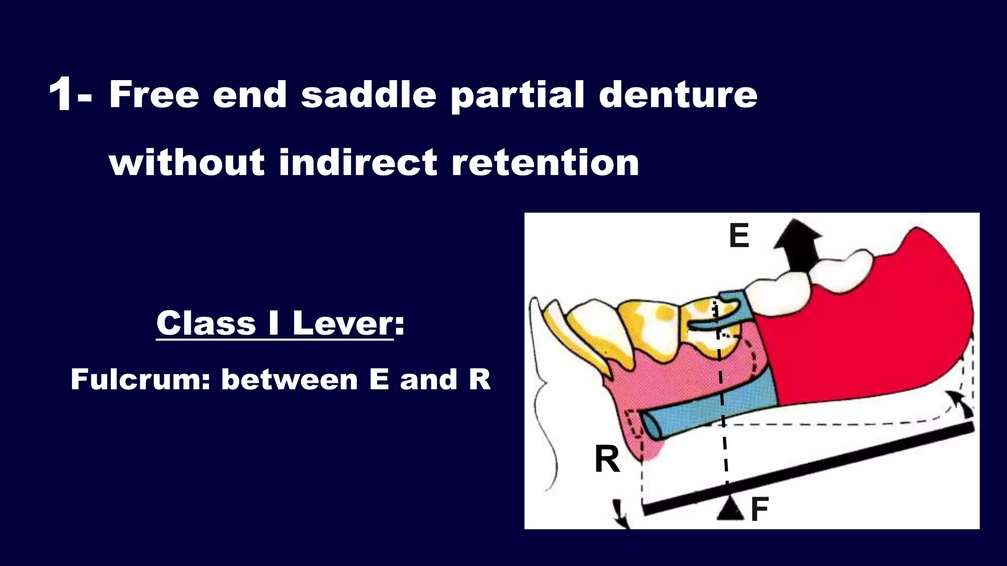 1. Introduction and forces acting on Removable Partial Denture (RPD). | PPT