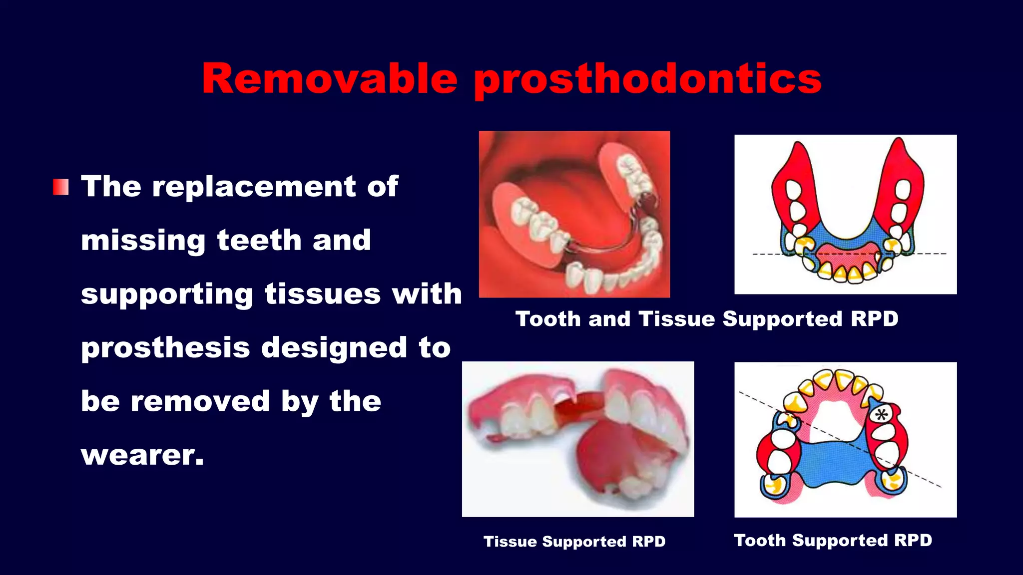 1. Introduction and forces acting on Removable Partial Denture (RPD). | PPT