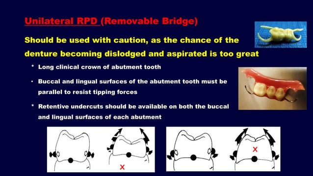 1. Introduction and forces acting on Removable Partial Denture (RPD). | PPT