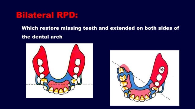 1. Introduction and forces acting on Removable Partial Denture (RPD). | PPT