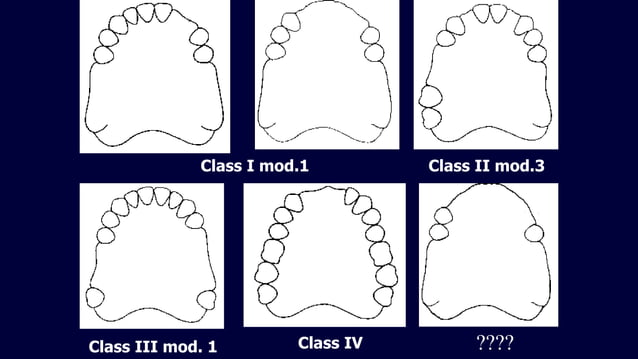 1. Introduction and forces acting on Removable Partial Denture (RPD). | PPT