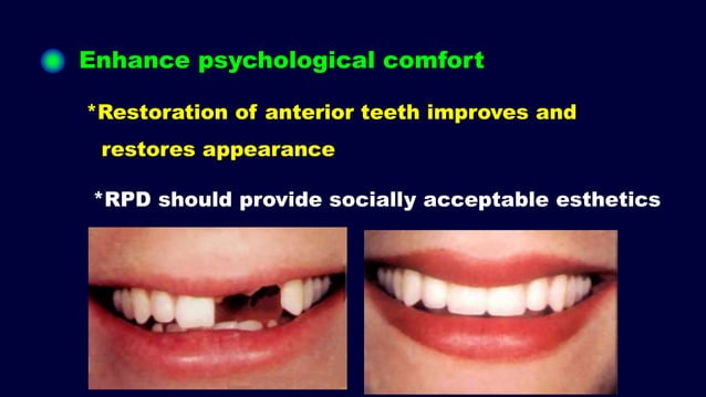 1. Introduction and forces acting on Removable Partial Denture (RPD ...