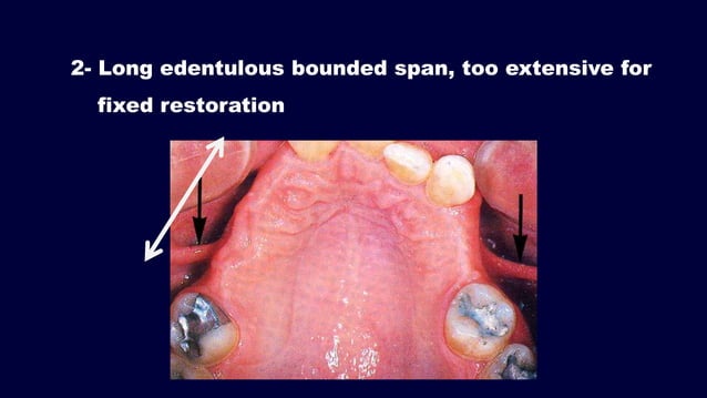 1. Introduction and forces acting on Removable Partial Denture (RPD). | PPT