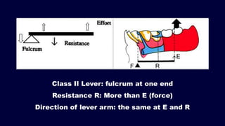 1. Introduction and forces acting on Removable Partial Denture (RPD ...