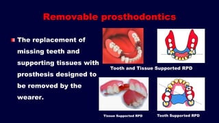 1. Introduction and forces acting on Removable Partial Denture (RPD ...