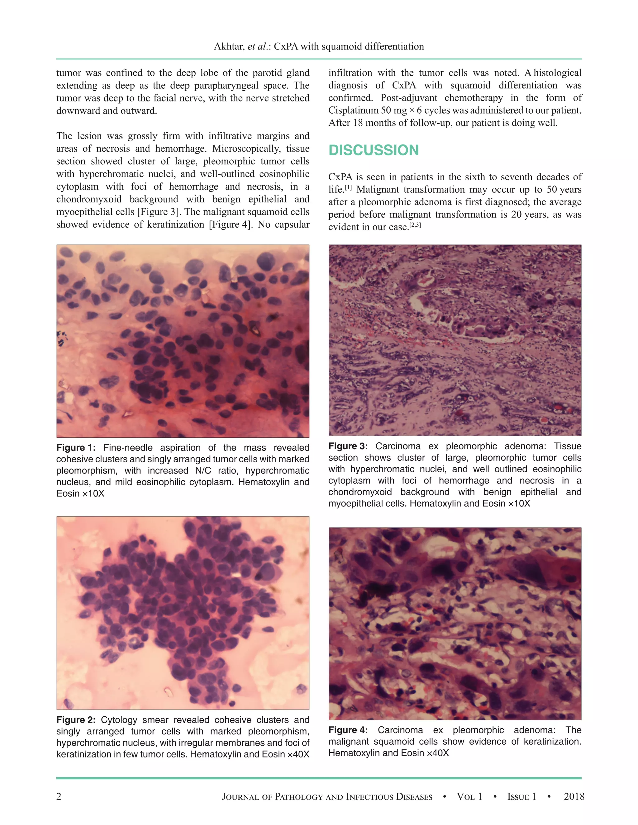 Carcinoma Ex-pleomorphic Adenoma with Squamoid Differentiation: An ...