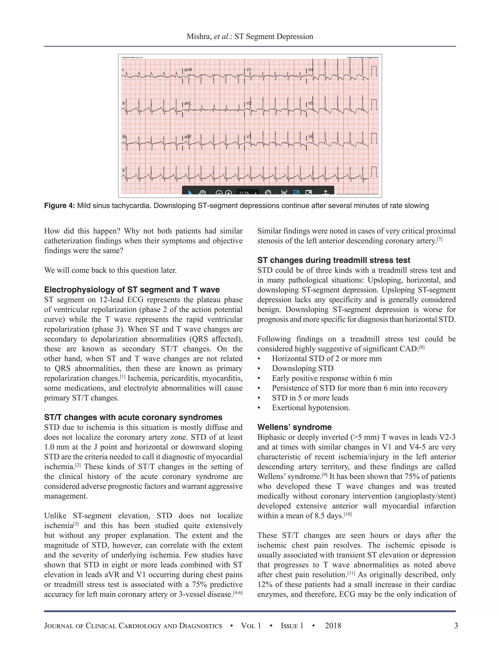 ST-segment Depression: All are Not Created Equal! | PDF