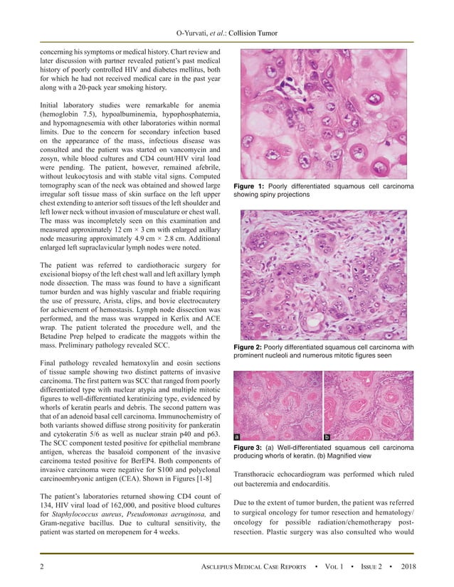 Collision Tumor of the Thorax | PDF