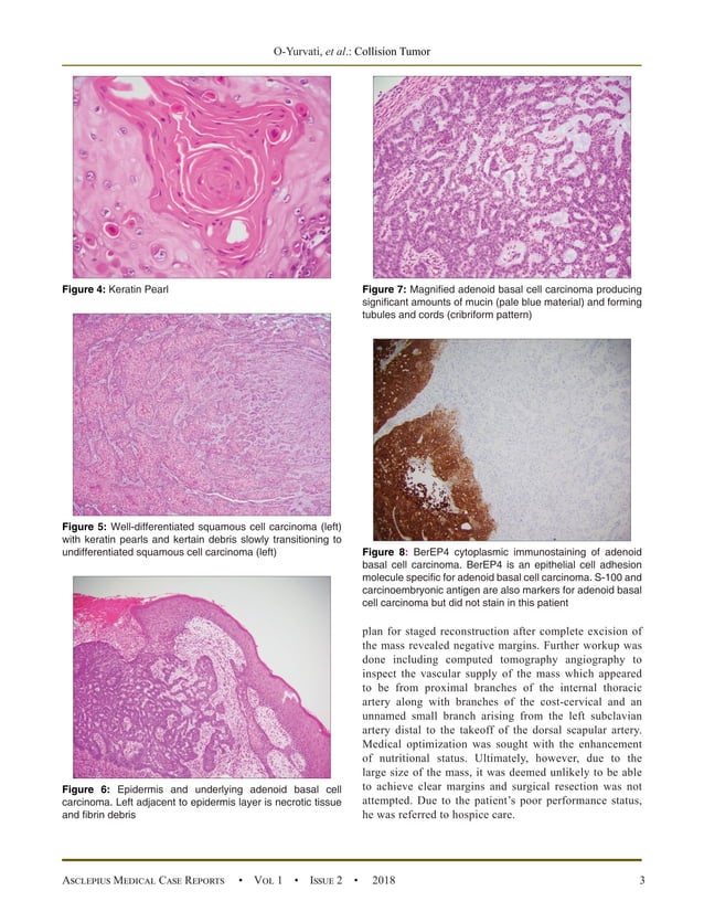 Collision Tumor Of The Thorax Pdf
