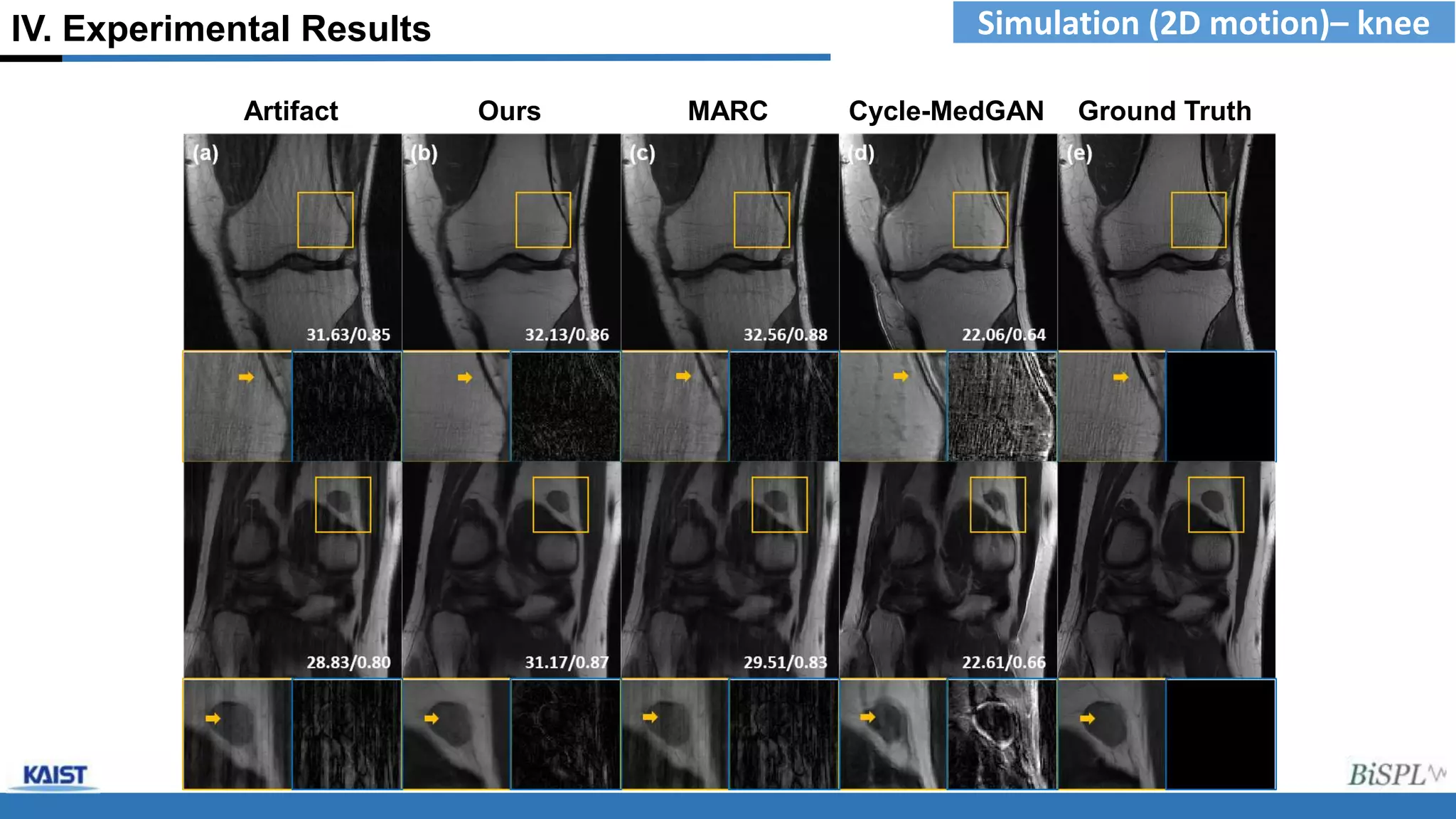 Unpaired Mr Motion Artifact Deep Learning Using Outlier Rejecting Bootstrap Aggregation Ppt