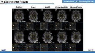 Unpaired MR Motion Artifact Deep Learning Using Outlier-Rejecting Bootstrap Aggregation | PPT