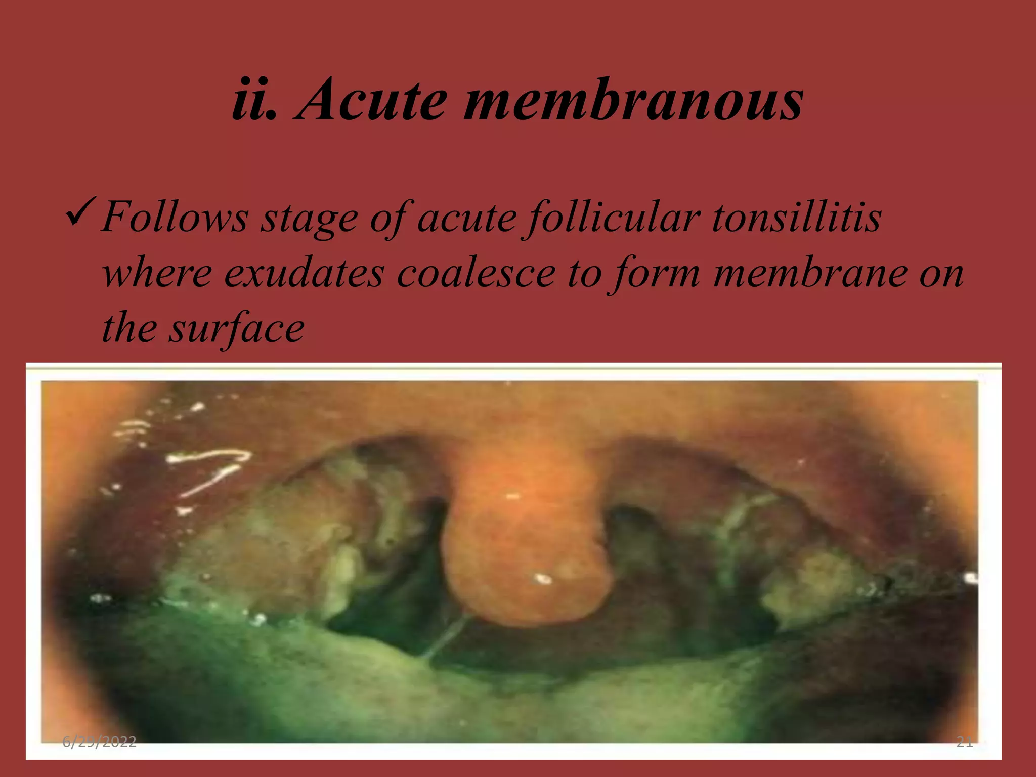 Tonsilitis | PPTX