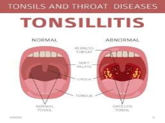 Tonsilitis | PPTX | Ear, Nose and Throat Conditions | Diseases and Conditions
