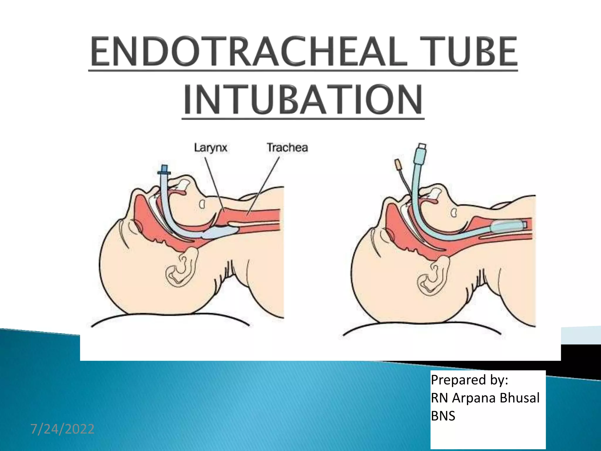 ET TUBE intubation | PPTX