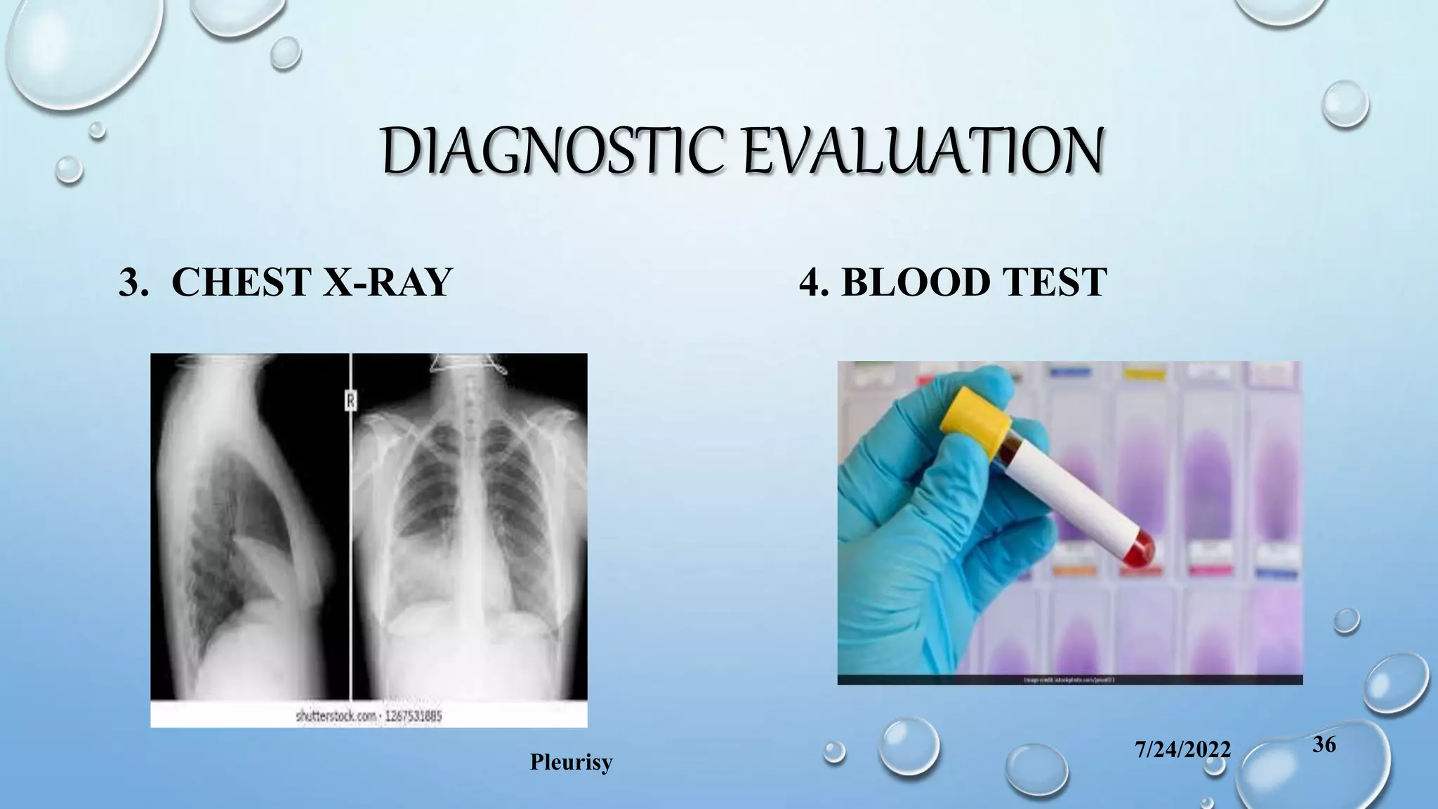 Pleurisy | PPTX