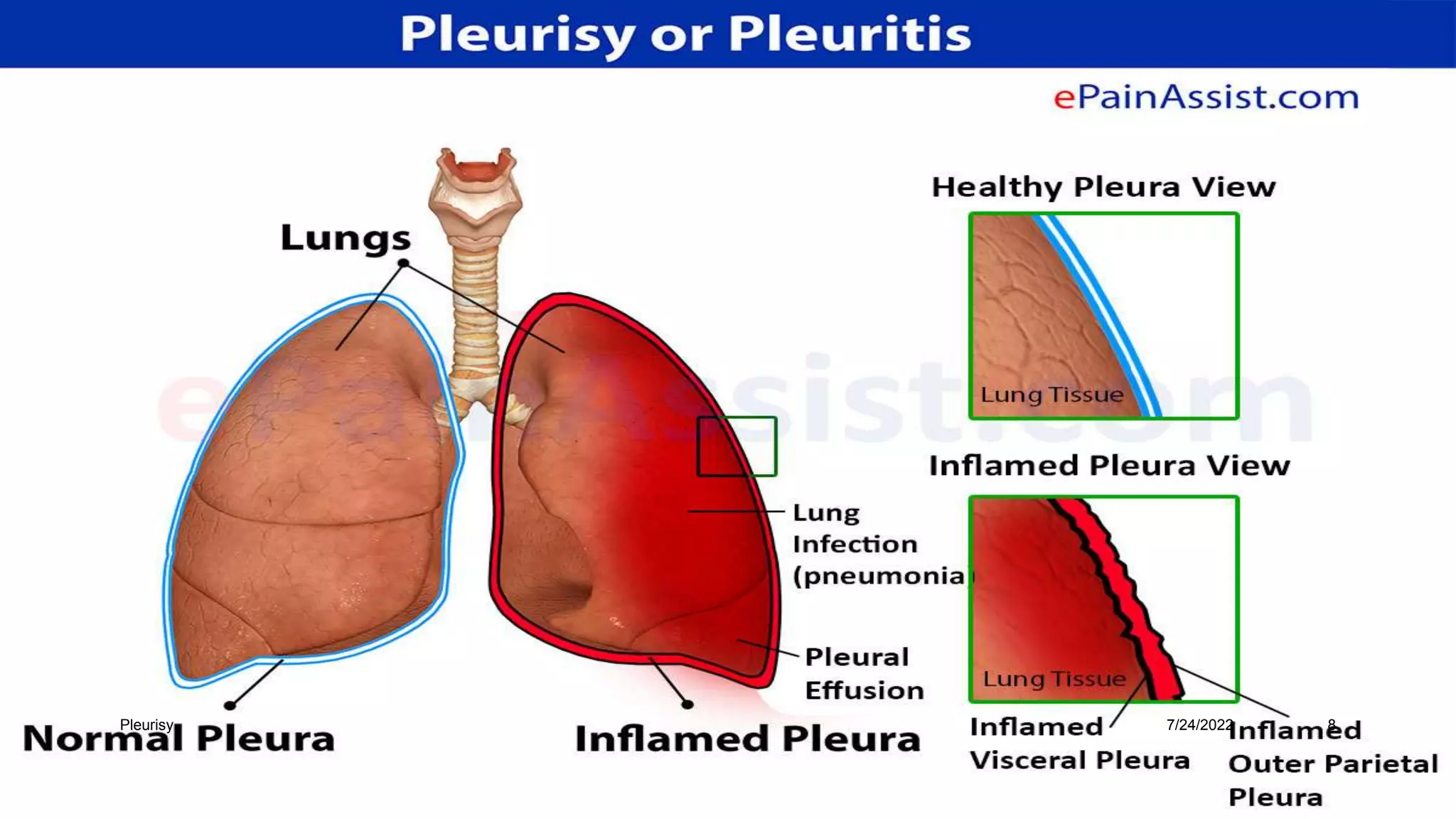Pleurisy | PPTX