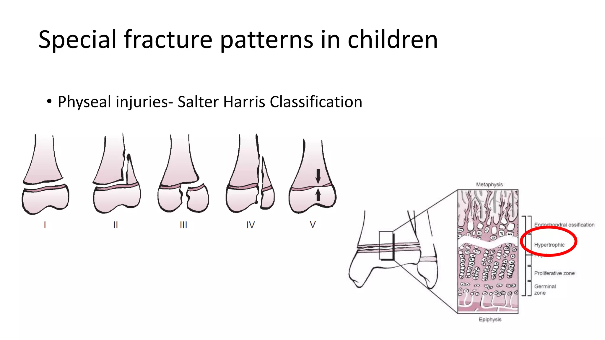 Fractures: Definiton, Diagnosis, Fracture healing , Complications.pptx