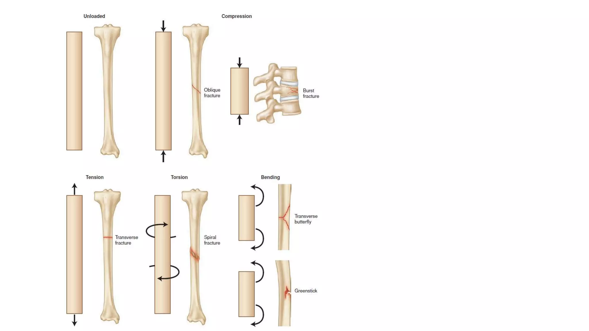 Fractures: Definiton, Diagnosis, Fracture healing , Complications.pptx
