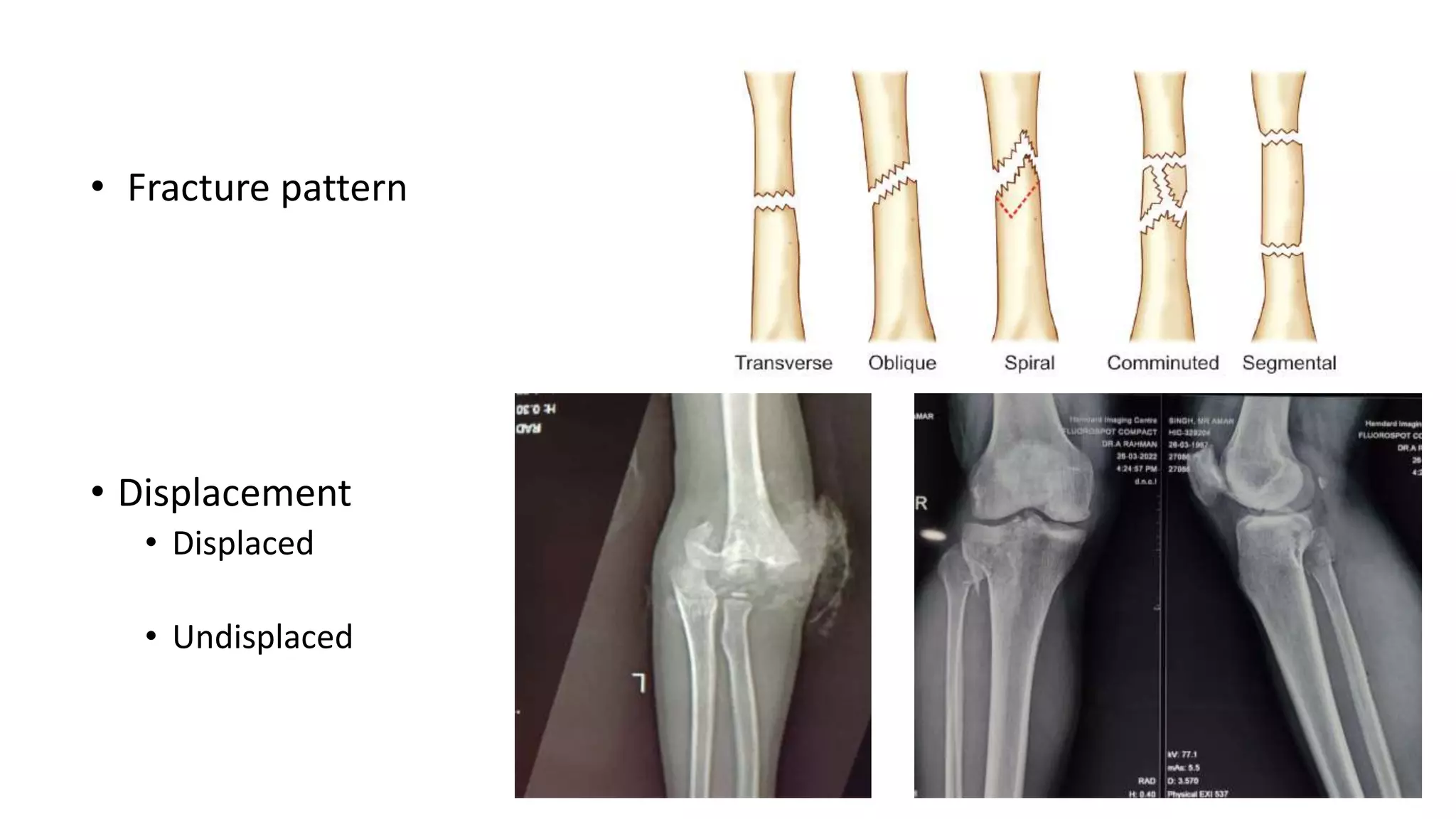 Fractures: Definiton, Diagnosis, Fracture healing , Complications.pptx