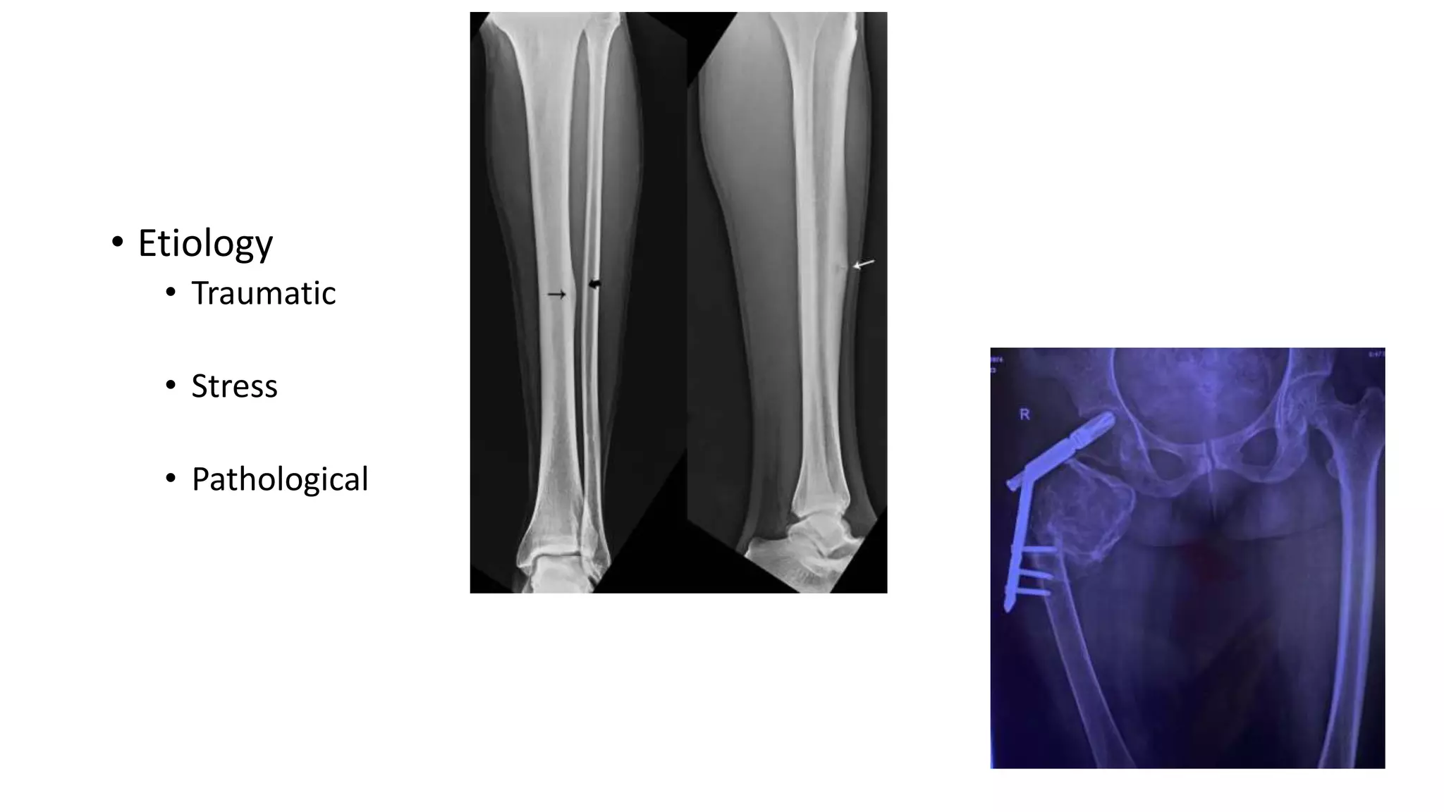 Fractures: Definiton, Diagnosis, Fracture healing , Complications.pptx