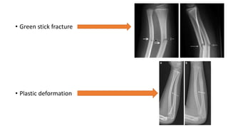 Fractures: Definiton, Diagnosis, Fracture healing , Complications.pptx