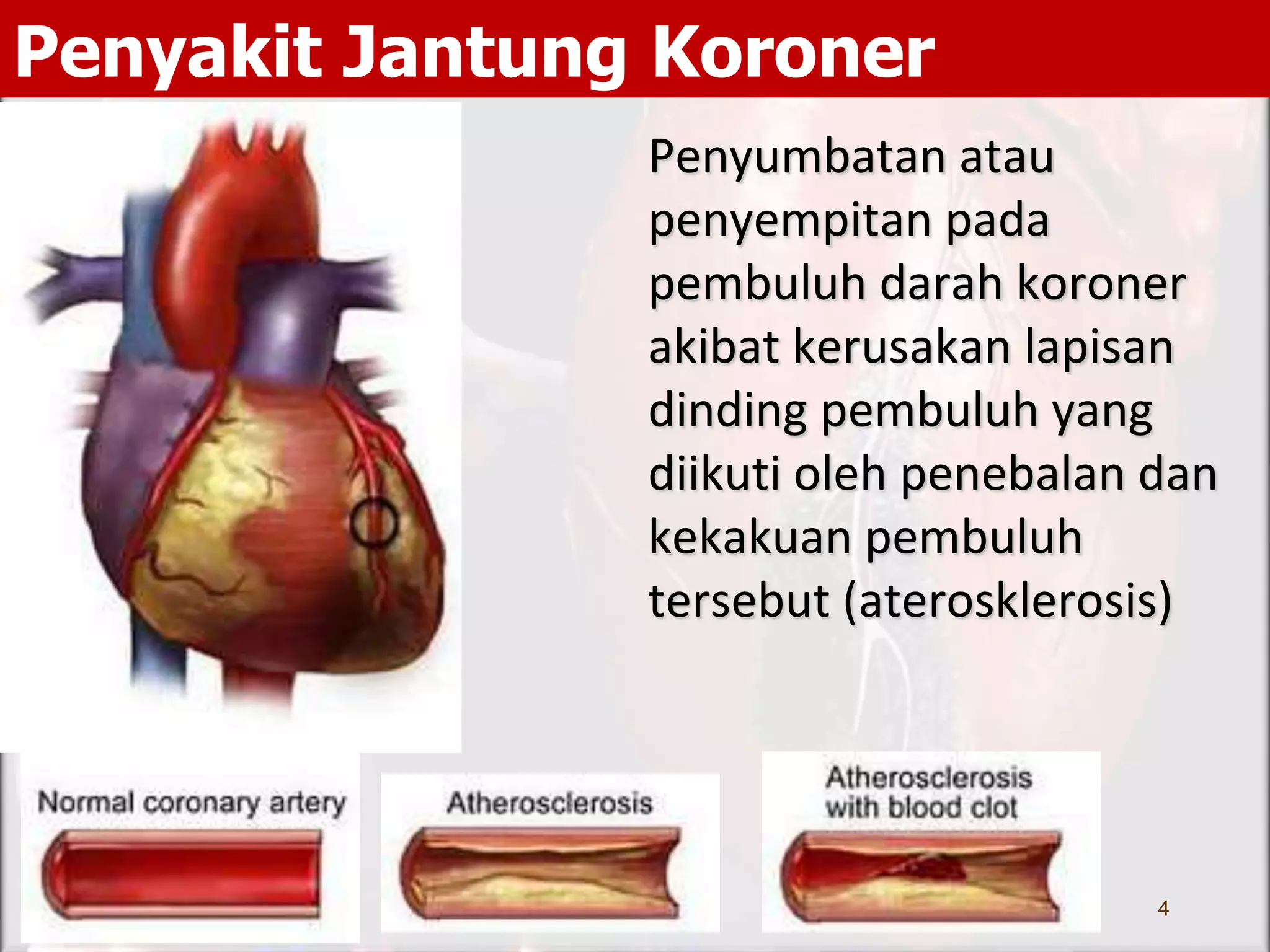 1. PJK dan Pencegahannya.ppt