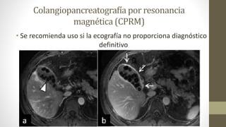 1.- Colecistitis y Piocolecisto.pptx