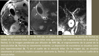 1.- Colecistitis y Piocolecisto.pptx