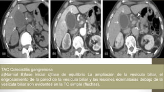 1.- Colecistitis y Piocolecisto.pptx