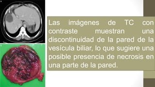 1.- Colecistitis y Piocolecisto.pptx