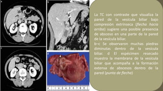 1.- Colecistitis y Piocolecisto.pptx