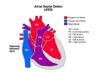 1.ACHD-ASD-VSD.ppt
