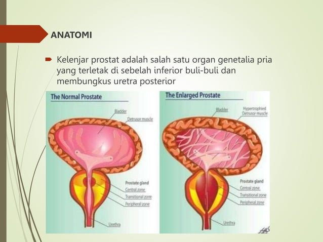 1. PPT BPH.pptx