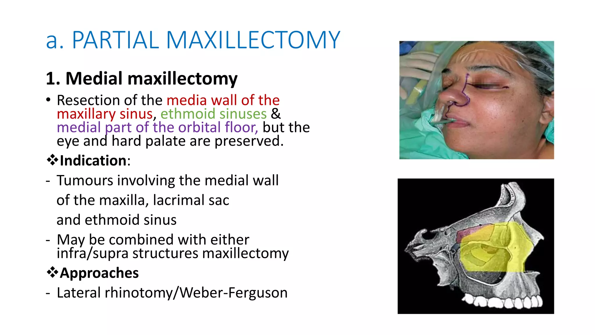 1. MAXILLECTOMY.pptx
