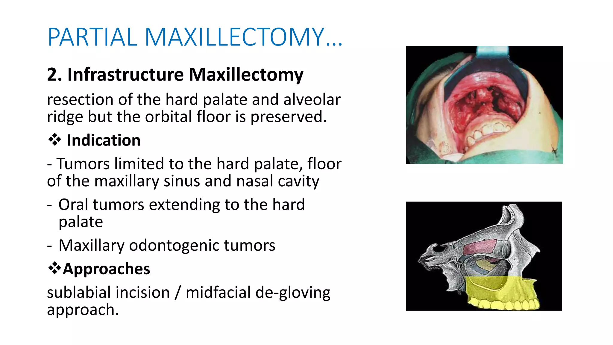 1. MAXILLECTOMY.pptx