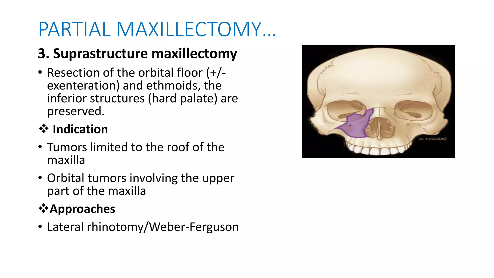 1. MAXILLECTOMY.pptx
