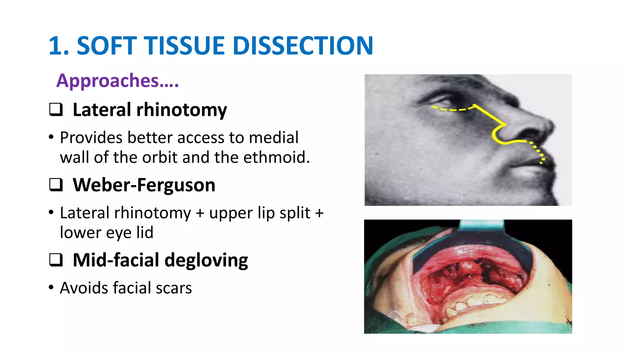 1. MAXILLECTOMY.pptx